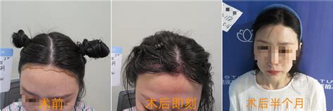 植发1000单位有多大面积 知乎