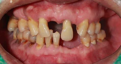 항암치료 후 빠진 치아 임플란트 수면마취잘하는치과 네이버 블로그