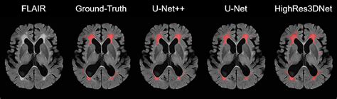 comparison of the wmh reference and the predicted segmentation from