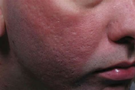 Aknenarben Mit Laser Entfernen Lassen Wien Dr Wallentin