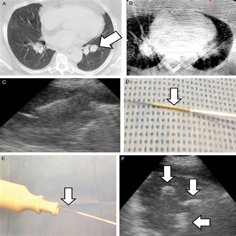 Fiducial Marker Placement Via Convex Probe Ebus Journal Of