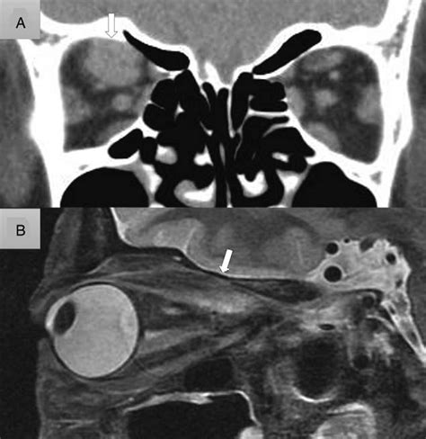 Series Of Clinical Imaging Scans Showing The Development Of Compressive