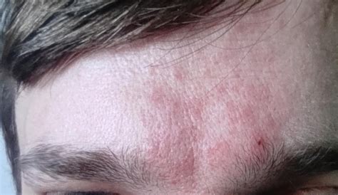 Knee Problems And Psoriasis Rpsoriasis
