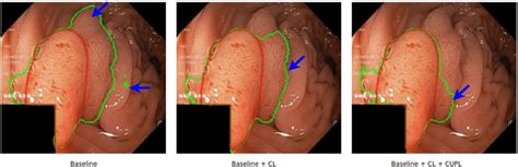 Some Pseudo Labels Of Polyp Segmentation Obtained By CL And The CUPL On Download Scientific
