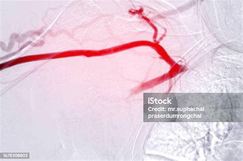Image Of Angioplasty Balloon Angioplasty And Percutaneous Transluminal