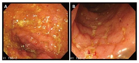 Pouchitis And Pre Pouch Ileitis Developed After Restorative Proctocolectomy For Ulcerative