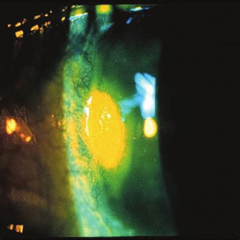 The 3 And 9 Oclock Corneal Staining Induced By Rigid Gas Permeable
