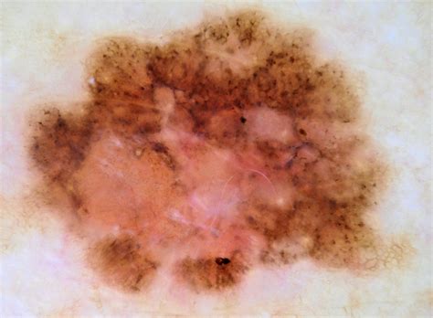 Dermoscopy Melanoma Skin Cancer Can Be Fatal Unless Caught Early But
