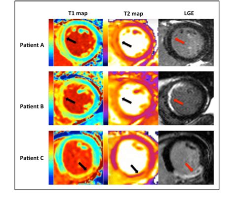 Representative Mid Left Ventricular Short Axis T1 Maps T2 Maps And Lge