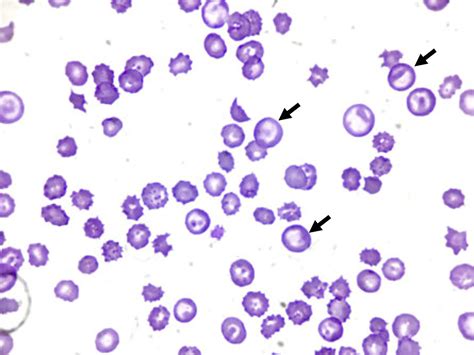 Figure 13 — Variation In Cell Size Anisocytosis The Cells Marked