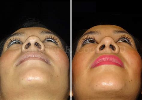 Rhinoplasty In Dallas Tx Nose Job Nose Surgery
