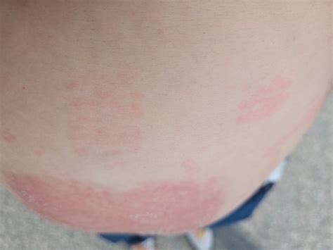 붕대 테이프 알러지 인가요 지식in