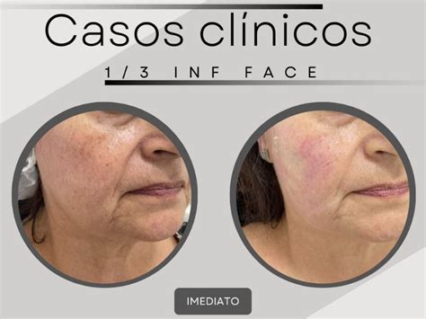 SKINLIFTING ENDOLIFT ENDOLASER