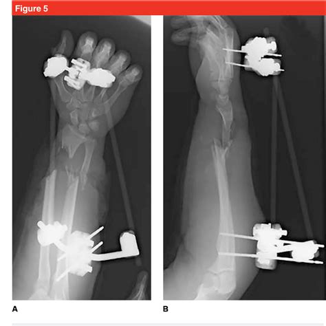 Figure 5 From Management Of Adult Diaphyseal Both Bone Forearm