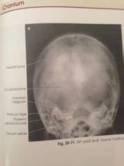 RTE 221 AP Axial Projection Of Skull Towne Method Flashcards Quizlet