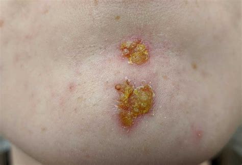 Types Of Impetigo Bullous Impetigo Non Bullous Impetigo And Their