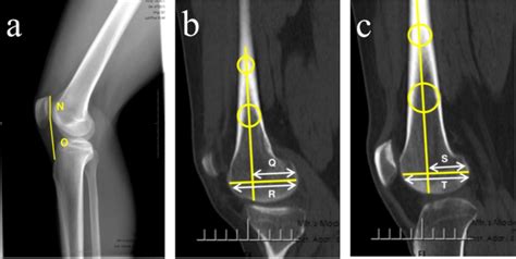 Measurements Of Patellar Height In The A Plane And Femoral Condyle