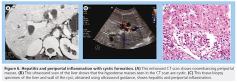 Abdominal Ultrasound Findings In Hiv And Tuberculosis