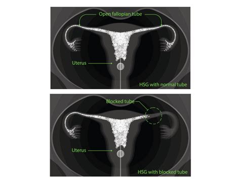Hysterosalpingogramhsg Test Cost Risks Success Rate Procedure