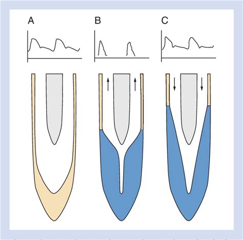 Figure 5 From Secondary Spread Of Caudal Block As Assessed By Ultrasonography Semantic Scholar