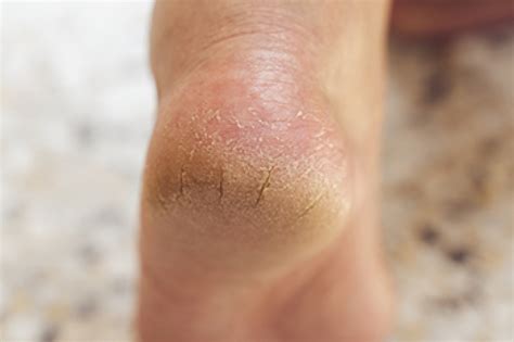 Exploring The Causes Of Cracked Heels