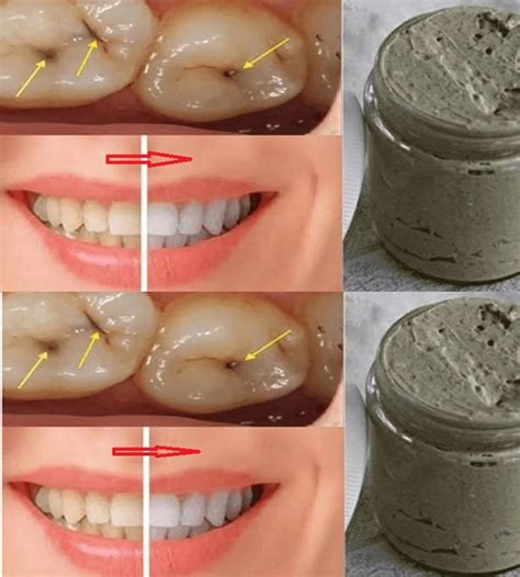 Homemade Toothpaste That Whitens Teeth Treats Cavities And Gum Disease