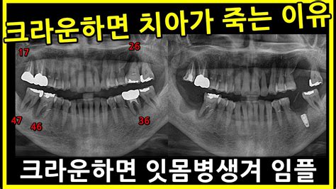 크라운하면 치아가 죽는 이유 크라운 치아사망 크라운과 잇몸병의 관계 잇몸병세균가설은 미신이다 잇몸병교합가설이 진실이다 치아가 죽든말든 크라운부터 씌우고 보려는 치과