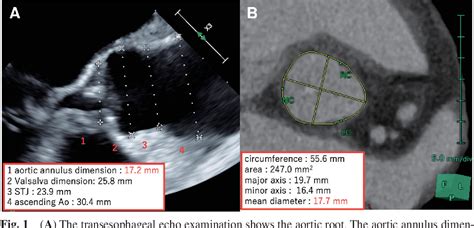 Figure 1 From Aortic Annular Enlargement With Modified Y Incision