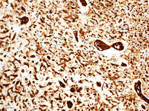 Pathology Outlines Hemangioblastoma