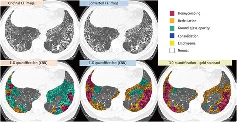 Generative Adversarial Network Based Image Conversion Among Different Computed Tomography