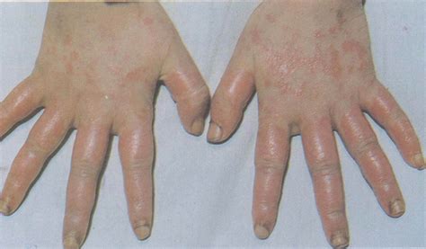 二、肠病性肢端皮炎 临床皮肤病及性病彩色图谱