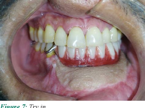 Figure 7 From Marginal Mandibulectomy Defect Rehabilitated With Cast Partial Denture A Case