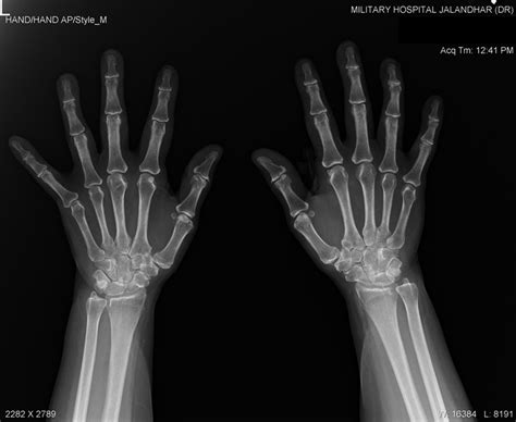 Bilateral Hand‐wrist Radiographs Download Scientific Diagram