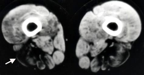 Dysferlin Deficiency