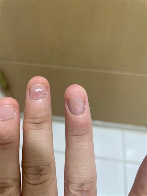 손톱 위 부음 지식in