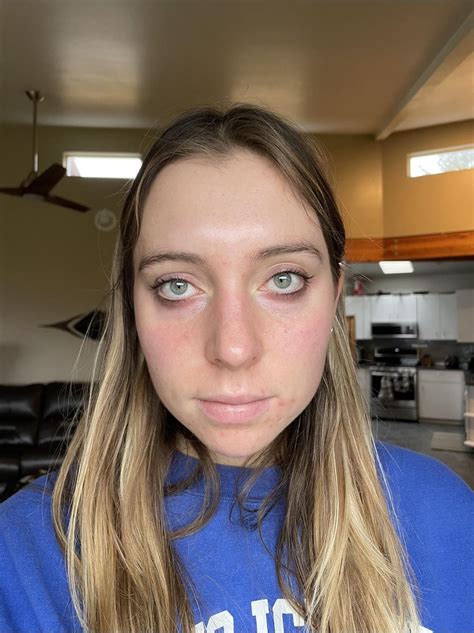 5 Months In R Tretinoin