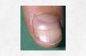 What Causes These HORIZONTAL Ridges In My Fingernails Appalachian Spring Dermatology