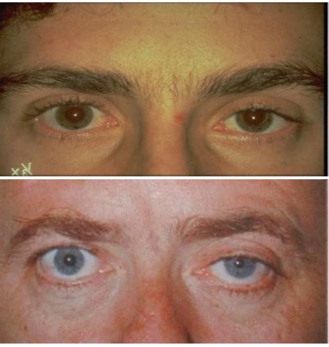 W1 Eyelid Conjunctival Disorders Flashcards Quizlet