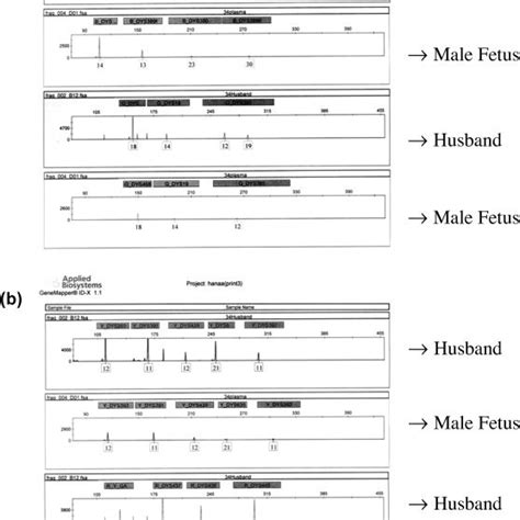 A Electropherogram Showing A Comparison Between A Maternal Plasma