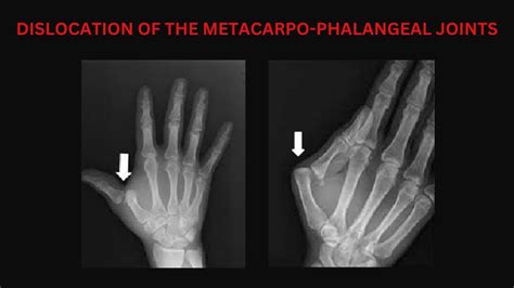 Dislocation Of The Metacarpo Phalangeal Joints Mcp Joint Dislocation