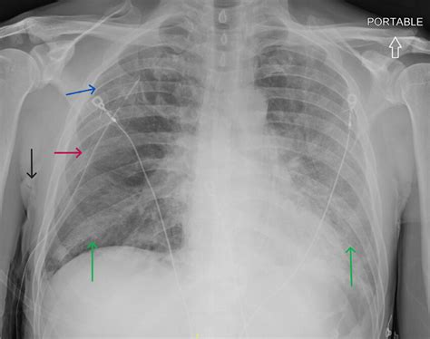 Chest X Ray Depicting A Right Sided Chest Tube Red Arrow Minimal