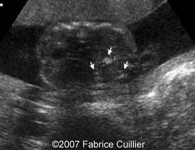 Idiopathic Liver Calcifications