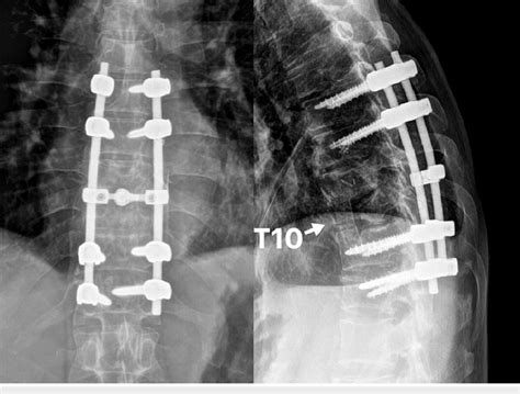 Postoperative Spine Radiograph Download Scientific Diagram