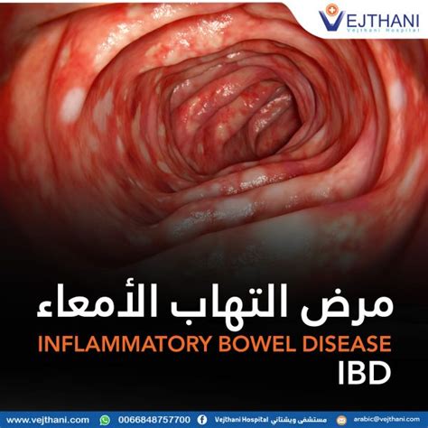 مرض التھاب الأمعاء Ibd Vejthani Hospital Jci Accredited