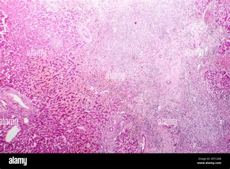 Histopathology Of Liver Abscess Light Micrograph Hematoxylin And