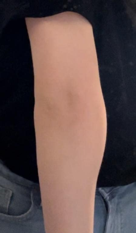 The Iv Nurse Missed My Vein My Arm Is Swollen With Anesthesia And