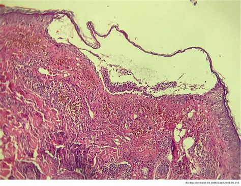 Acute Localized Exanthematous Pustulosis Induced By Paclitaxel Anais