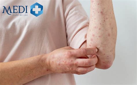Bệnh giang mai có chữa được không Bằng cách nào