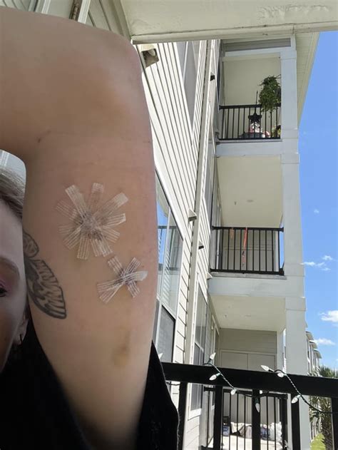 This Is My Third Time Getting Nexplanon Rnexplanon