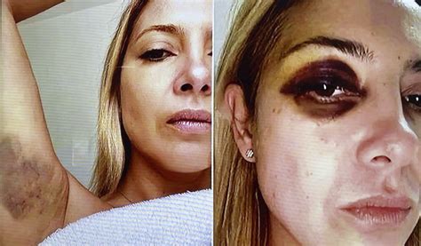 Filtran Fotos De Fabiola Yañez Con Golpes Tras La Denuncia Contra